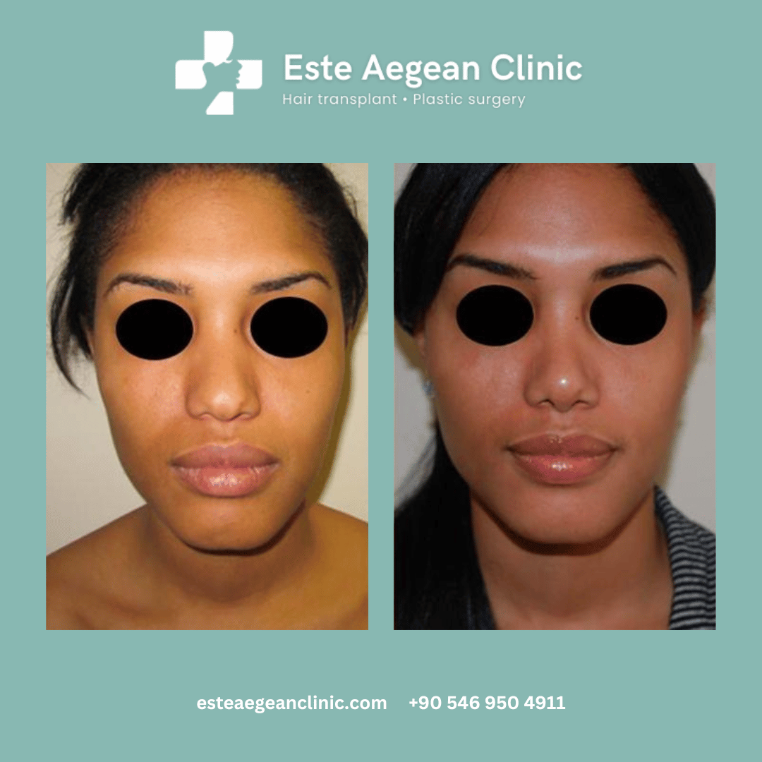 Ethnic Rhinoplasty Turkey - Este Aegean Clinic