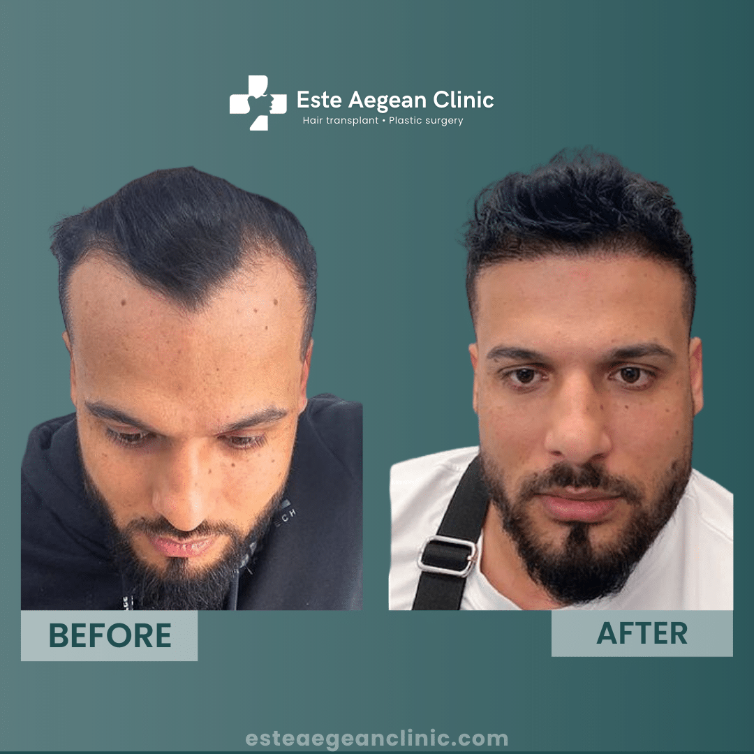 Before - After - Este Aegean Clinic