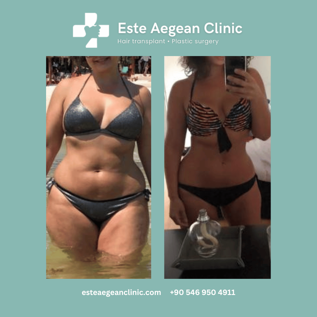 Gastric Balloon in Turkey - Este Aegean Clinic