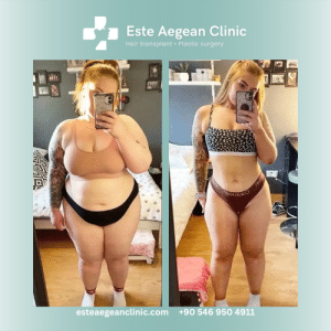 Gastric Bypass Turkey - Este Aegean Clinic